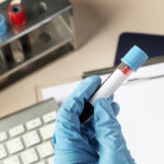 CA 125 biljeg - tumorski marker za tumor jajnika Medikol