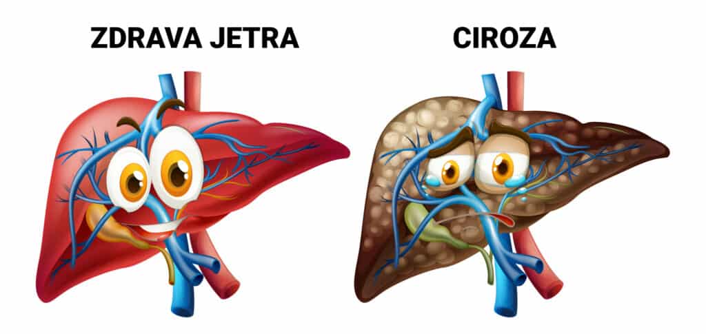 Masna jetra i ciroza - Poliklinika Medikol